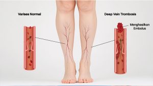 Perbedaan Varises dan Deep Vein Thrombosis (DVT) – Jakarta Varices Clinic